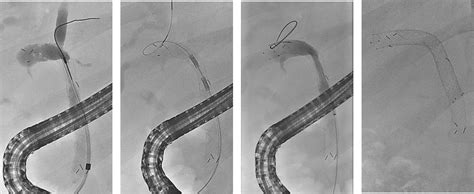 Endobiliaire Radiofrequente Ablatie Ter Preventie En Behandeling Van