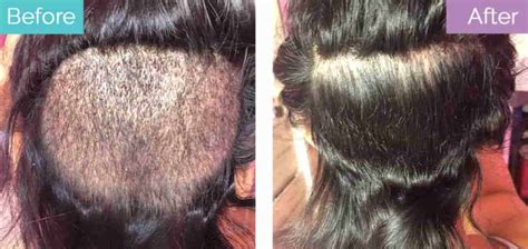 What Is A Donor Area Longevita Hair Transplant