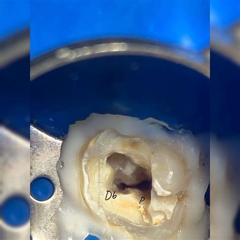 Dr Mohammed Ahmad On Linkedin Rare Anatomy In Maxillary First Molar Usually If There Is A