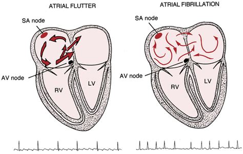 Supraventricular Arrhythmias Part Ii Atrial Flutter And Atrial Fibrillation Clinical Gate