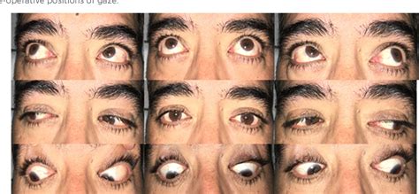 Cranial Nerve Iv Trochlear Nerve Palsy 42 Off