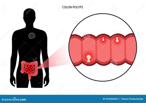 Colon Polyps Inflammation Stock Vector Illustration Of Body 225690420