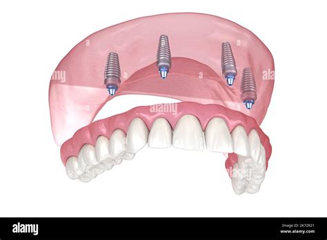 Maxillary Prosthesis With Gum All On 4 System Supported By Implants Medically Accurate 3d