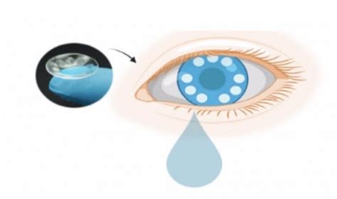 Lentillas Capaces De Detectar Cáncer