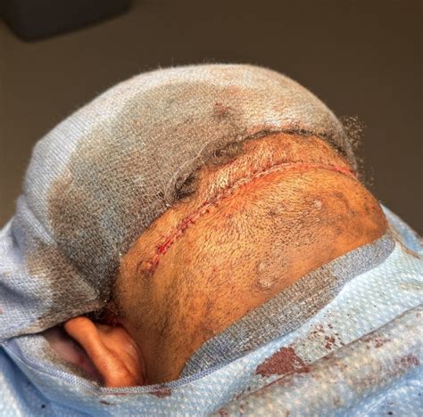 Plastic Surgery Case Study Reduction Of The Male Single Occipital Scalp Roll Explore Plastic