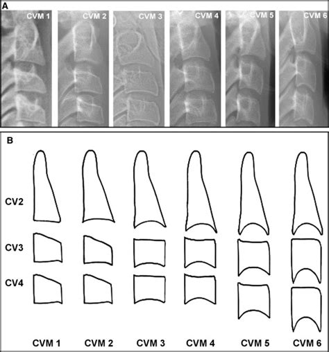 Racial And Sex Differences In Timing Of The Cervical Vertebrae Maturation Stages Pocket Dentistry