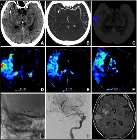 Representative Cases Axial Non Contrast Ct Image A Showing A Download Scientific Diagram