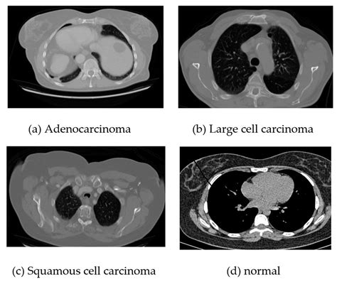 Attention Based Densenet For Lung Cancer Classification Using Ct Scan And Histopathological Images