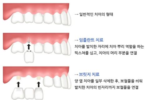 치아 브릿지의 장단점과 관리 방법 3가지