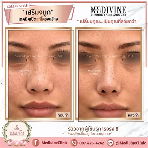 การทำจมูกแบบโอเพ่นปรับโครงสร้างจมูก ยืดผนังกั้นจมูก หรือ Open Rhinoplasty Nose Reconstruction