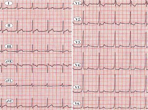 Kentov Zväzok Lokalizácia Pri Wpw Syndróme Ekg Kniha Techmed