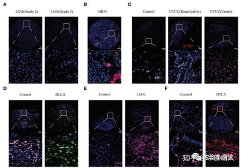 8 Sci，单基因泛癌生信 表达验证 单细胞泛癌。单基因泛癌的经典思路，不得不服，即便再过两年，仍然可以发文！ 知乎