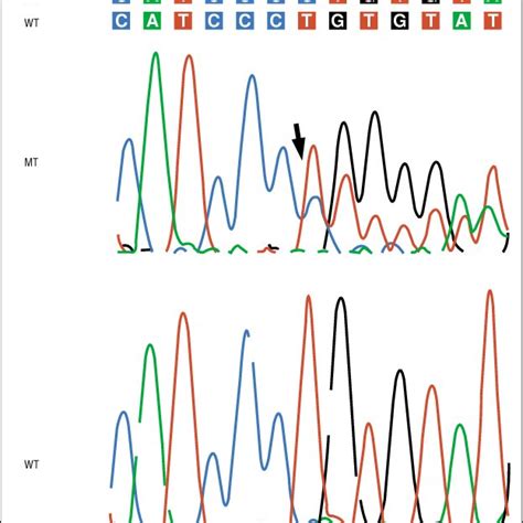 Chromatograms Of Mutated Mt Dna Of The Patient And Wild Type Wt Dna Download Scientific