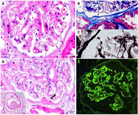 Guselkumab Associated Nephrotic Syndrome A Case Report Of Membranous