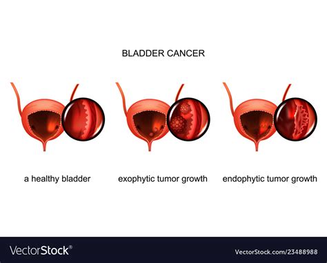 Exophytic And Endophytic Growth Of Cancer Vector Image
