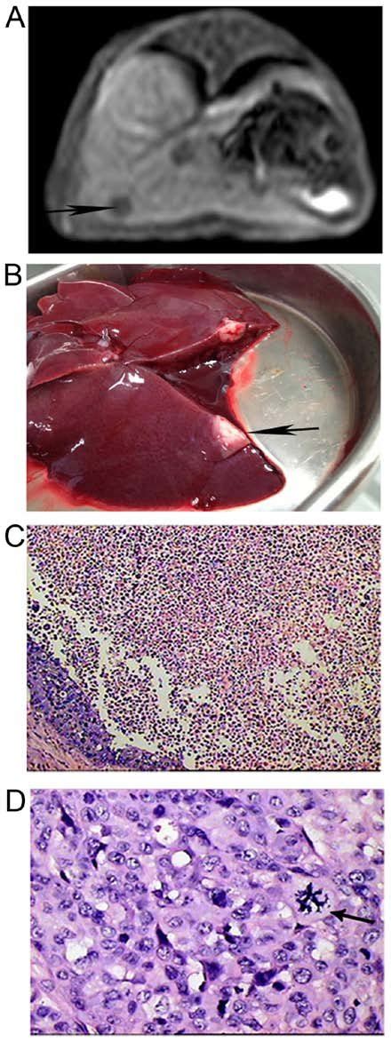 The Histological Findings Of The Rabbit Vx2 Hepatocarcinoma A D Are Download Scientific