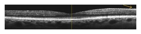 Spectral Domain Oct Linear Scans In The Macula Of A Normal Subject