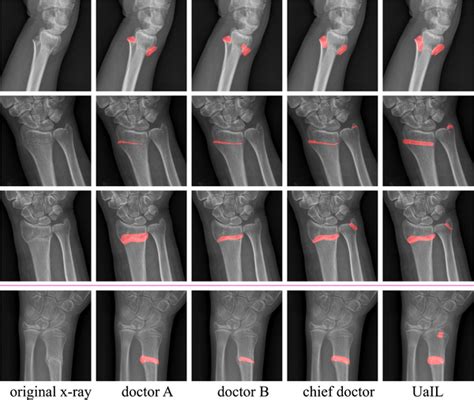 some examples of different doctor s annotations and segmentation from download scientific