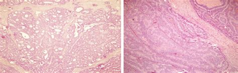 Synchronous Bilateral Breast Cancer In A Male Ecancer