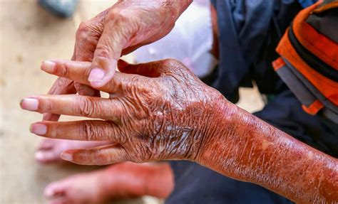 50 Facts About Systemic Sclerosis