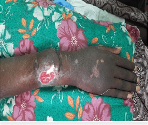 Figure 1 From Management Of Neglected Pubic Symphysis Diastasis And