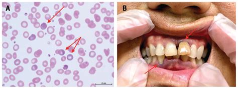 Basophilic Stippling Basophilic Stippling Of Erythrocytes In