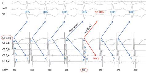 Electrogram Interpretation 12 Ep Essentials