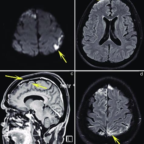 Contrast MRI Of Brain Showing A Bilateral Cortical Diffusion Download Scientific Diagram