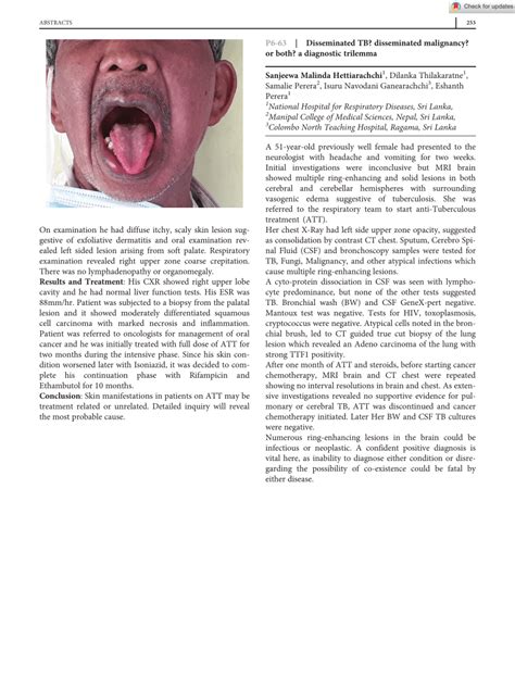 Pdf Respirology 2021 P6‐63 Disseminated Tb Disseminated
