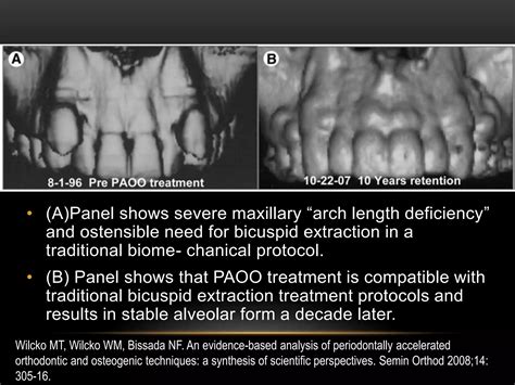 Corticotomy For Rapid Acceleration Pptx Dental Health Diseases And Conditions