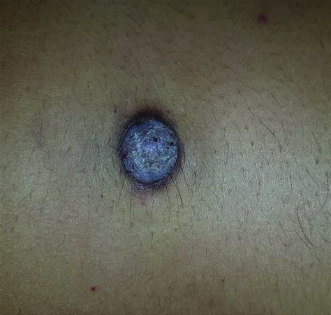 Ahead Of Print Indian Journal Of Dermatology Venereology And Leprology