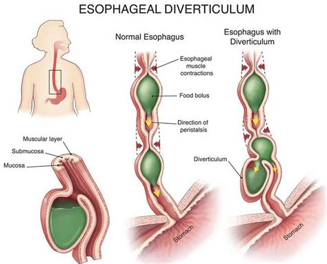 Epiphrenic Diverticulum