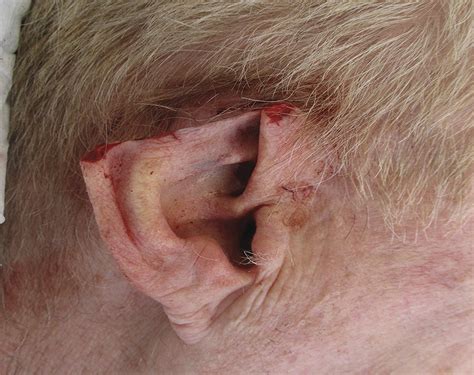 Reconstruction Of A Full Thickness Ear Defect Dermatologic Surgery