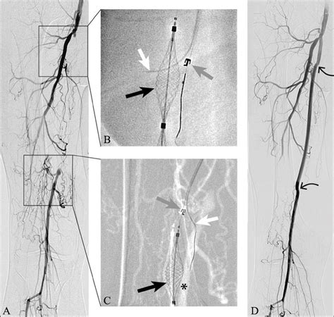 Pre Procedural Angiography Shows Occlusion Of Sfa With Patent Download Scientific Diagram