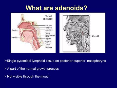 Adenoids Hypertrophy Ppt