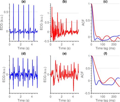 Table 1 From Supervised Svm Transfer Learning For Modality Specific Artefact Detection In Ecg