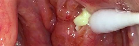 Tonsil Crypts Removal