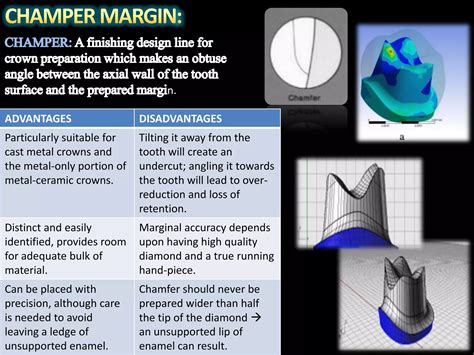 Different Gingival Finish Lines Margins Of Crowns And Bridges Pptx