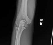 Standard Radiographs Elbow Wikism