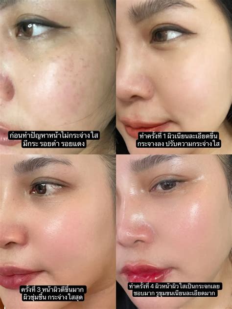 รีวิวเอง Pico หน้าใส หน้าเงาเป็นกระจก แกลเลอรีที่โพสต์โดย Auichocky Lemon8