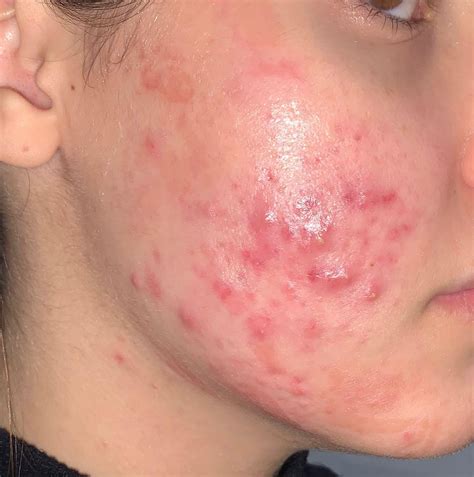 Hormonal Acne Before And After Birth Control Racne
