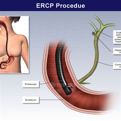 Ercp Photographs