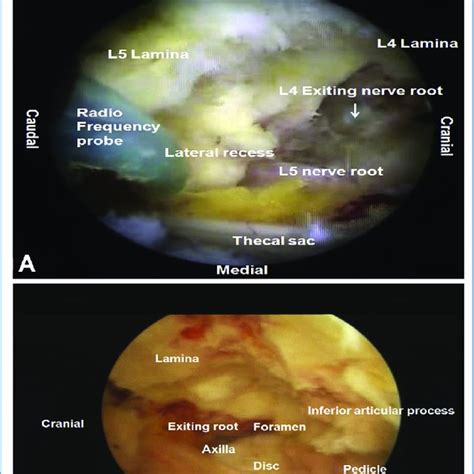 Endoscopic View Showing Decompression A Contralateral Decompression Download Scientific