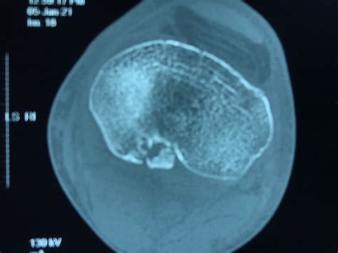 Knee Pcl Avulsion Fracture Avulsion Fracture Knee Replacement Knee