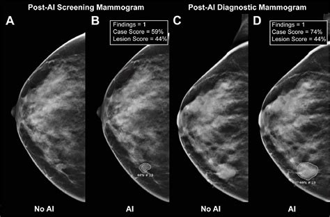 Improved Breast Cancer Detection With Artificial Intelligence In A Real World Digital Breast