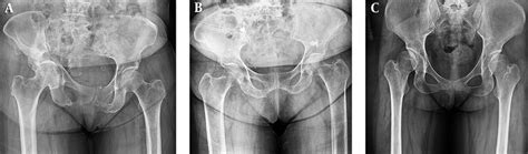 A A Proximal Femur Radiograph With Complete Agreement On Type B Of