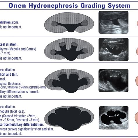 Utd Classification For Post Natal Hydronephrosis Download Scientific Diagram
