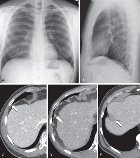 Diaphragm And Chest Wall Clinical Tree