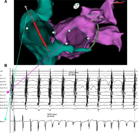 Atrial Fibrillation Cycle Length Measurement Within The Right And Left Download Scientific