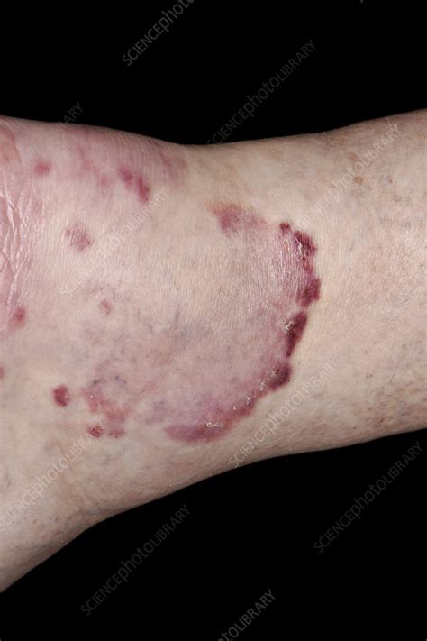 Ringworm Fungal Infection Stock Image C Science Photo Library